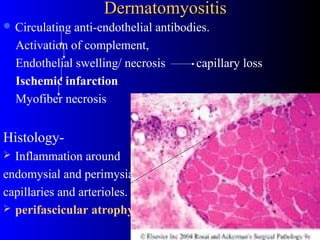 Muscle Atrophy Histology