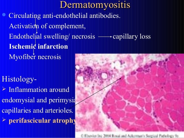Dermatomyositis Histology