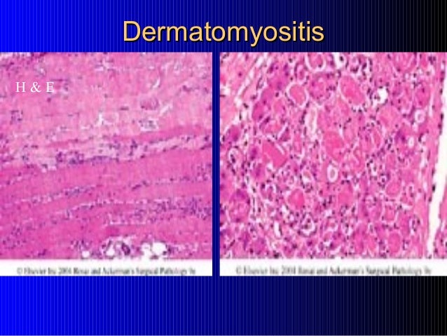 Dermatomyositis Histology