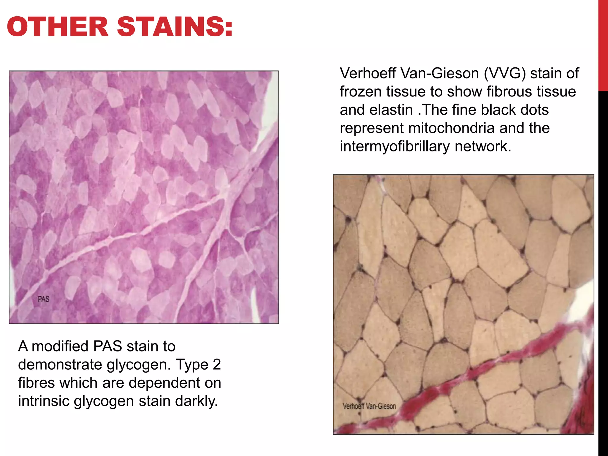 Muscle biopsy –INDICATIONS, processing and morphology.pptx