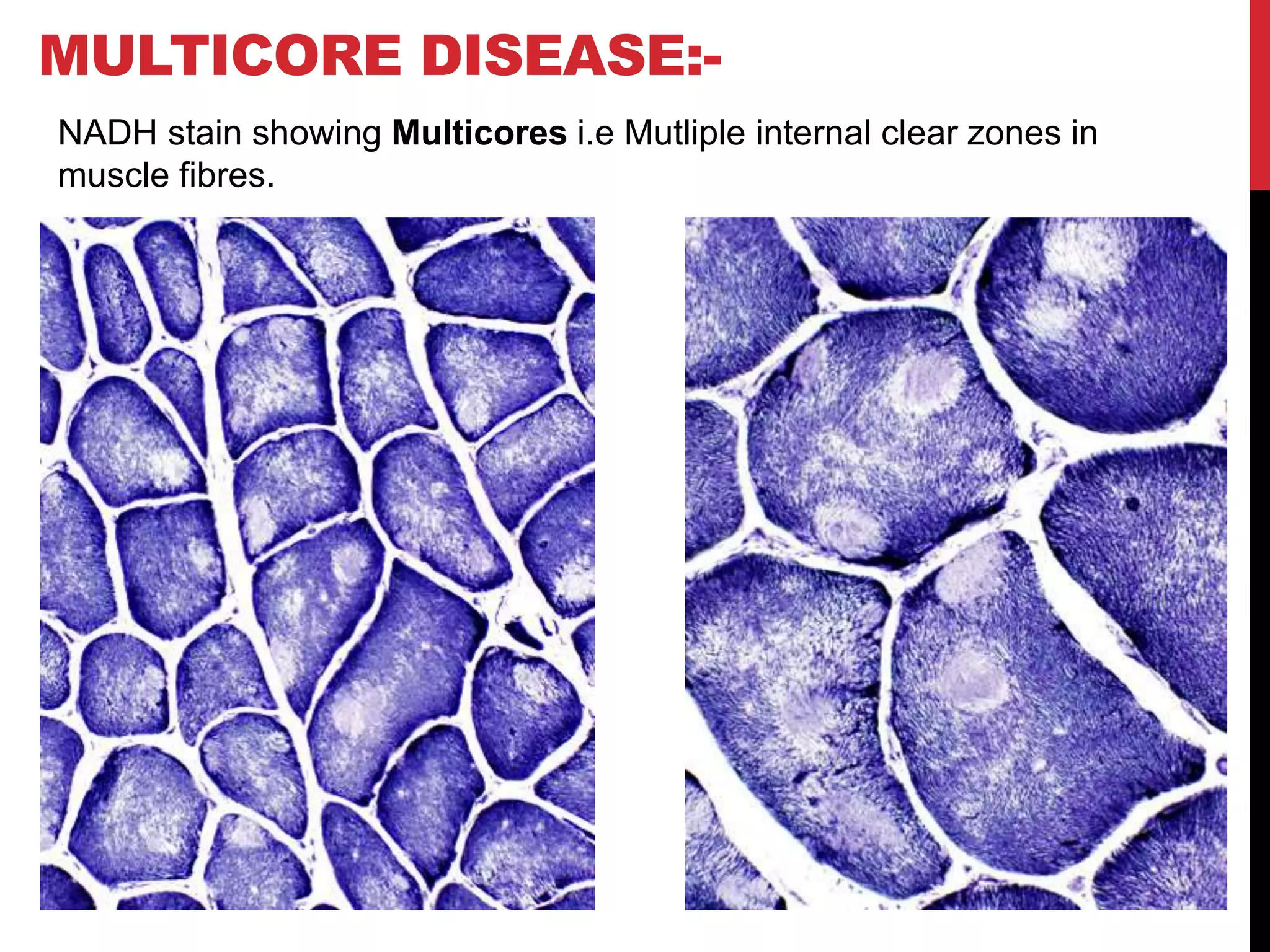 Muscle biopsy –INDICATIONS, processing and morphology.pptx | Physical ...