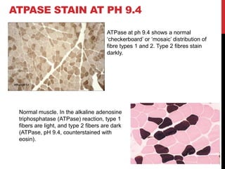 Muscle biopsy –INDICATIONS, processing and morphology.pptx