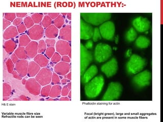 Muscle biopsy –INDICATIONS, processing and morphology.pptx
