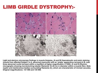 Muscle biopsy –INDICATIONS, processing and morphology.pptx