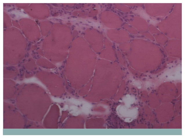 Muscle biopsy interpretation | PPTX | Physical Therapy | Wellness