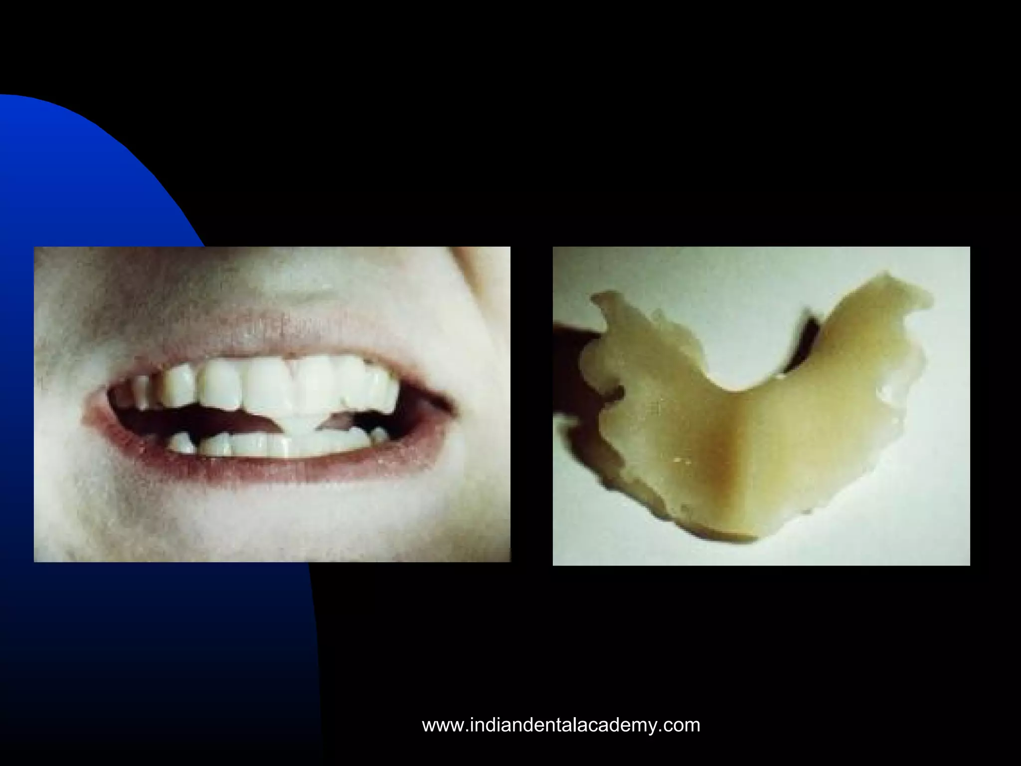 Muscle deprogramming /certified fixed orthodontic courses by Indian ...