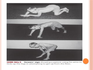 Muscle dystrophies and Approach to muscle disease.pptx