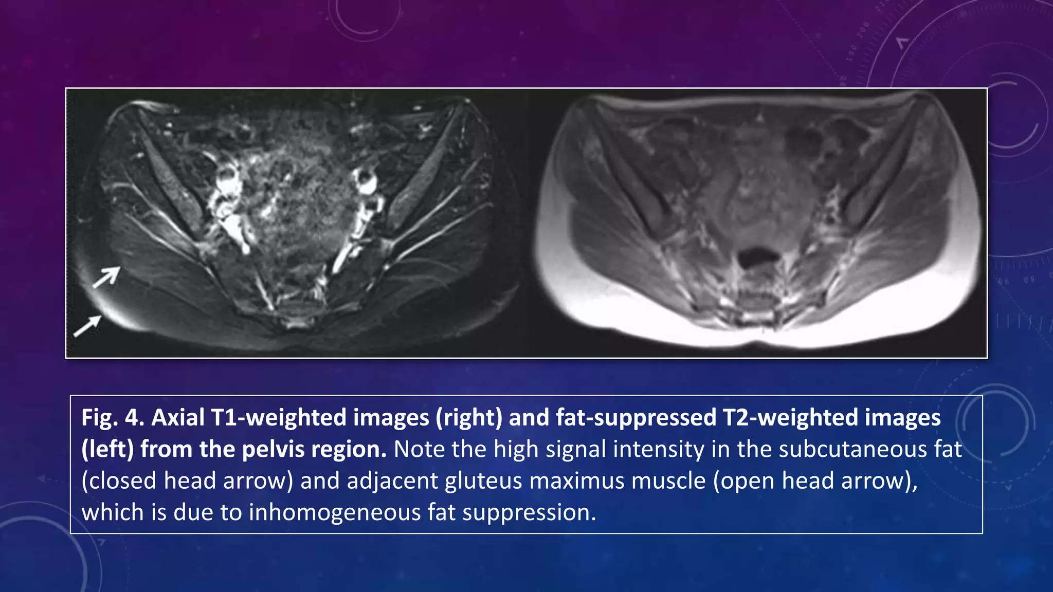 Muscle MRI in Neuromuscular Disease | PPTX