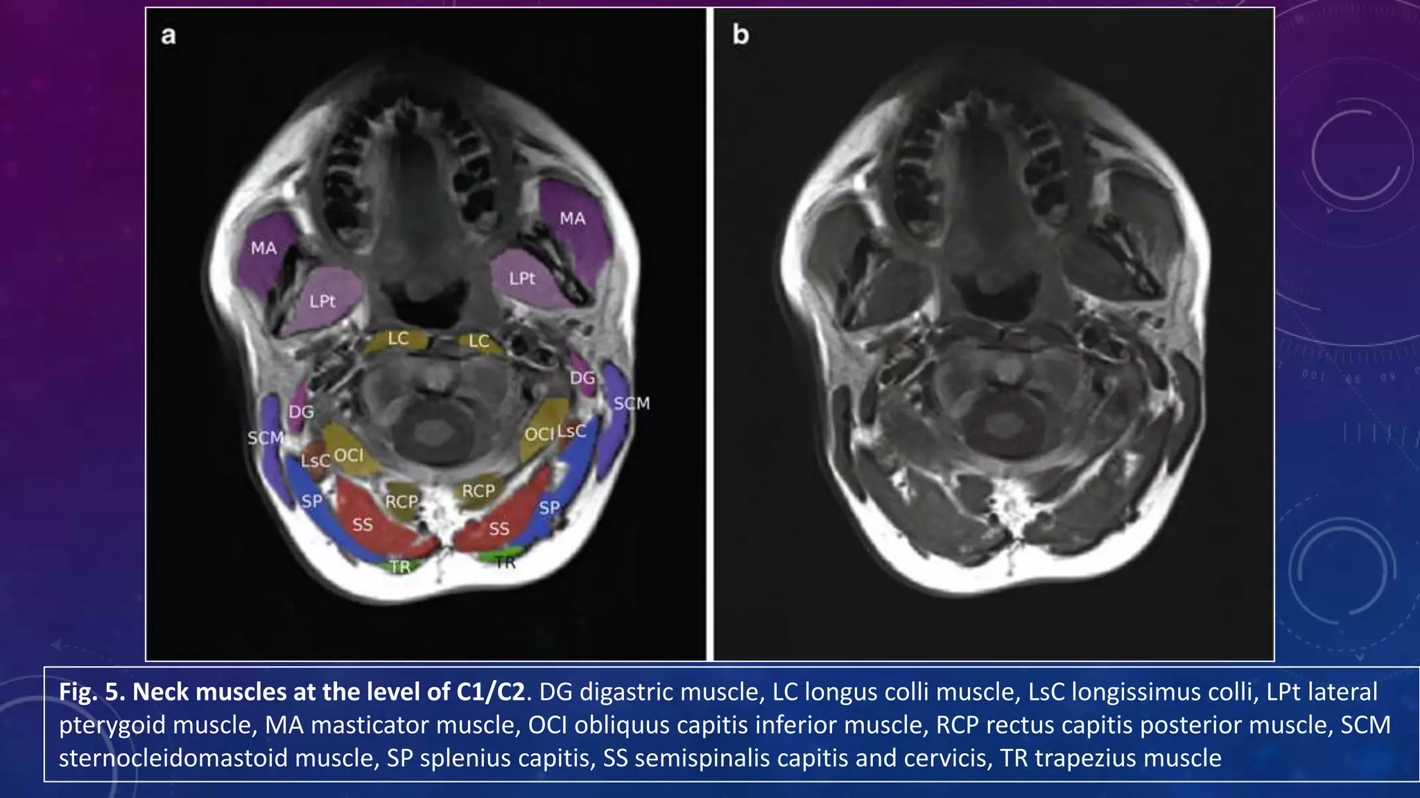 Muscle MRI in Neuromuscular Disease | PPTX