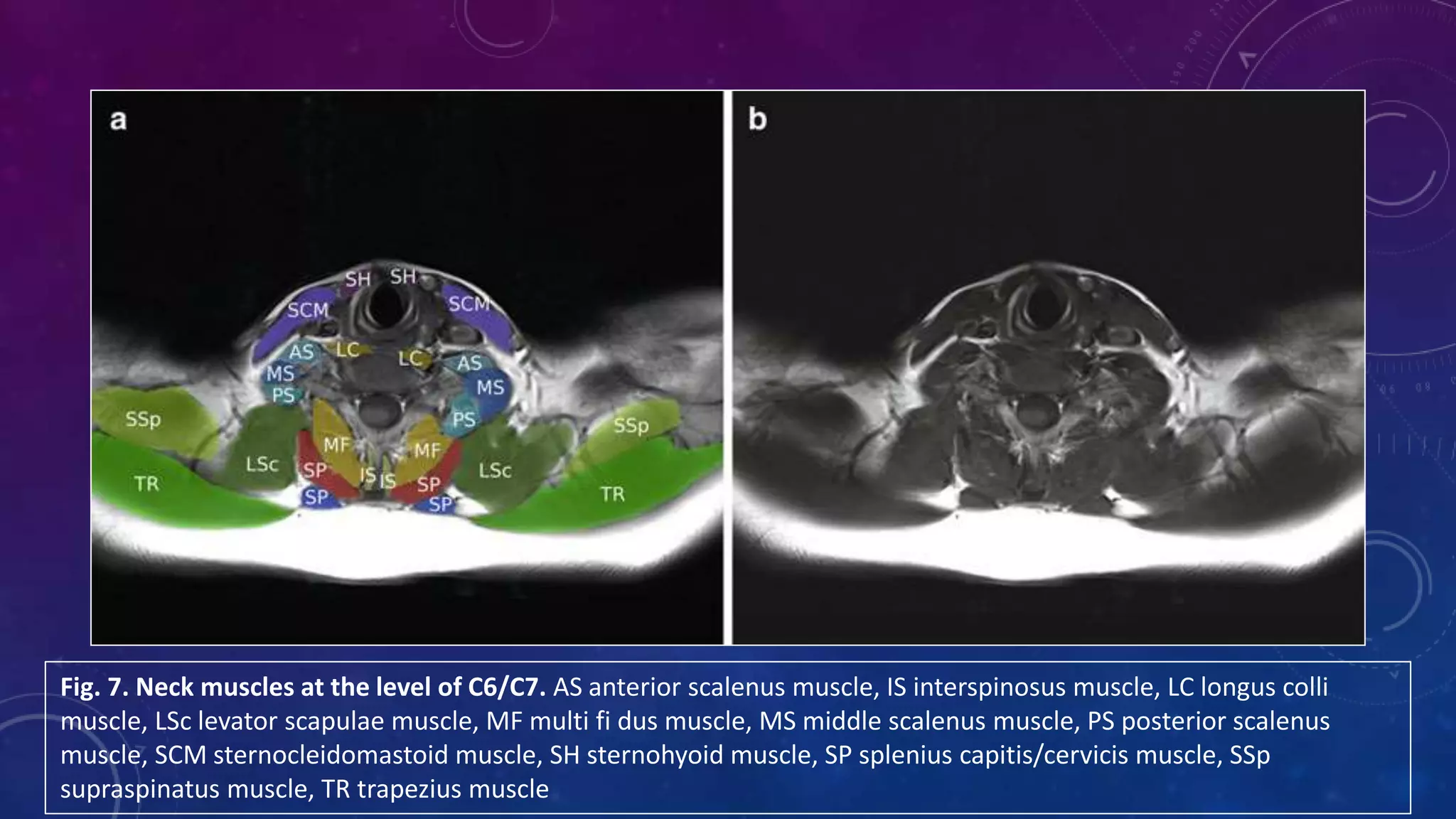 Muscle MRI in Neuromuscular Disease | PPTX