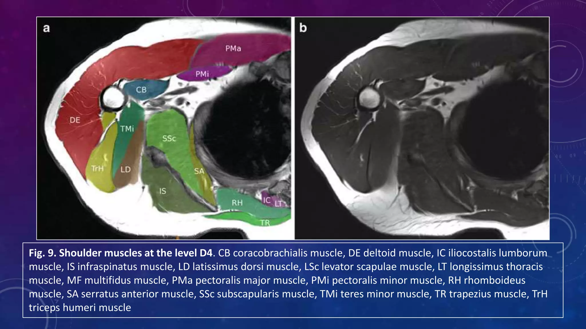 Muscle MRI in Neuromuscular Disease | PPTX