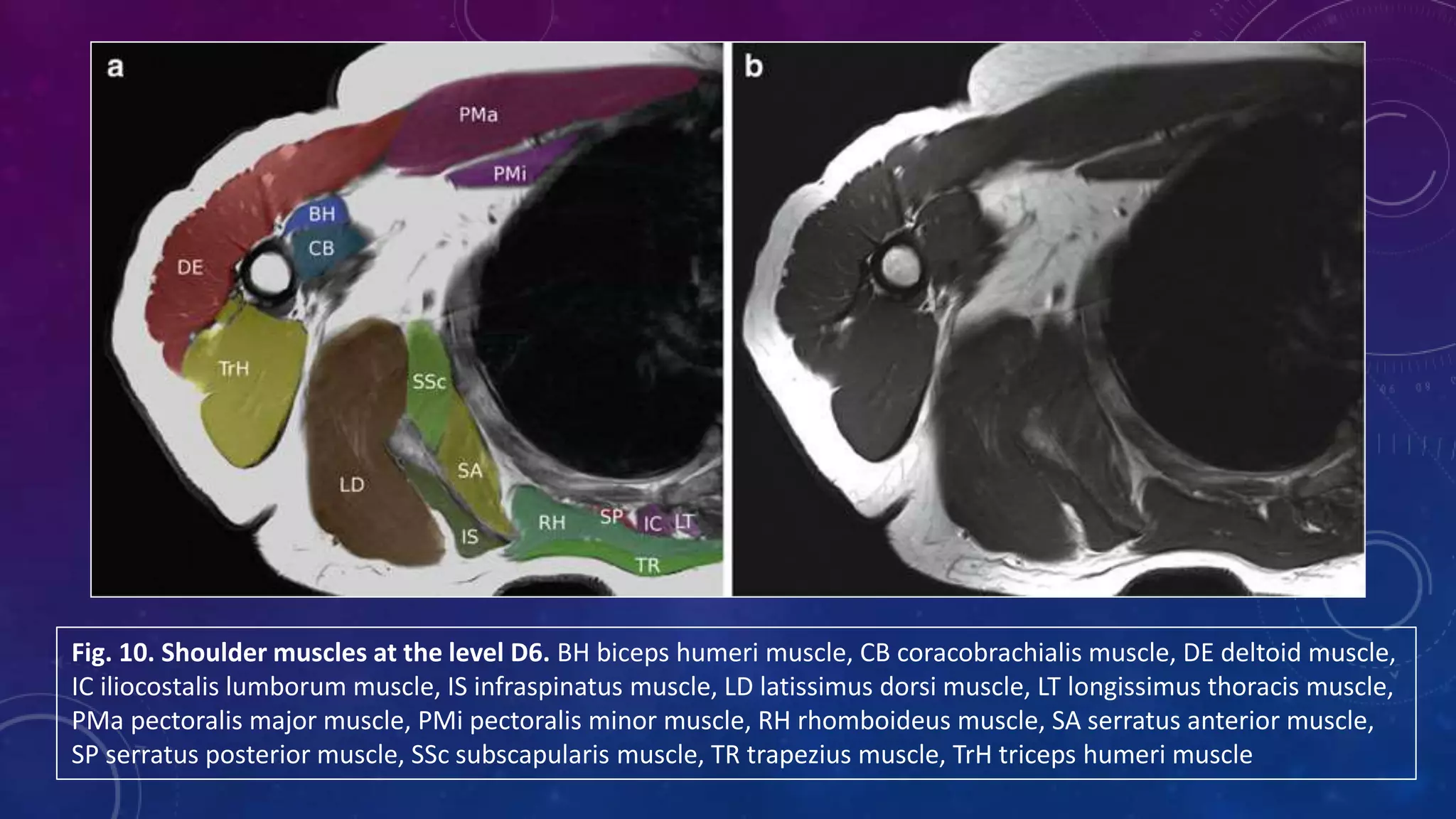 Muscle MRI in Neuromuscular Disease | PPTX