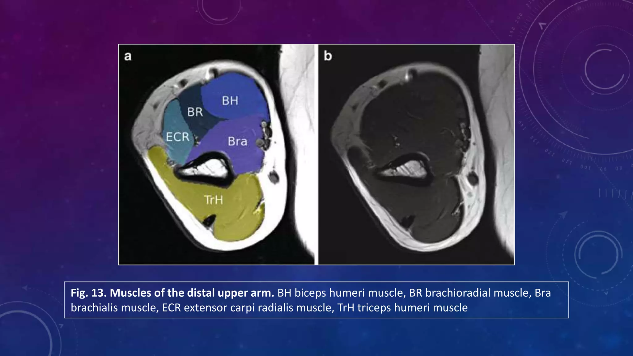 Muscle MRI in Neuromuscular Disease | PPTX