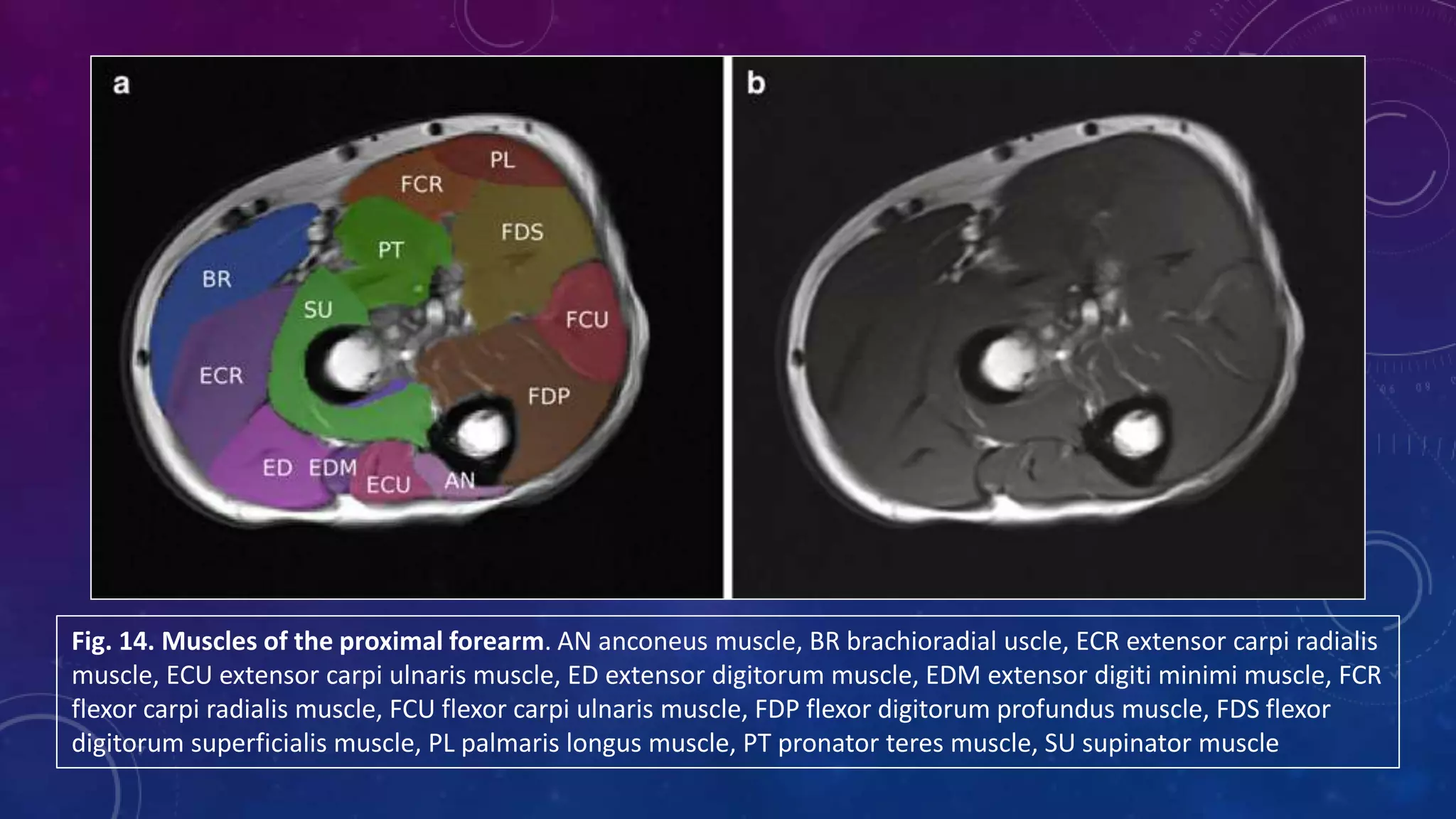 Muscle MRI in Neuromuscular Disease | PPTX