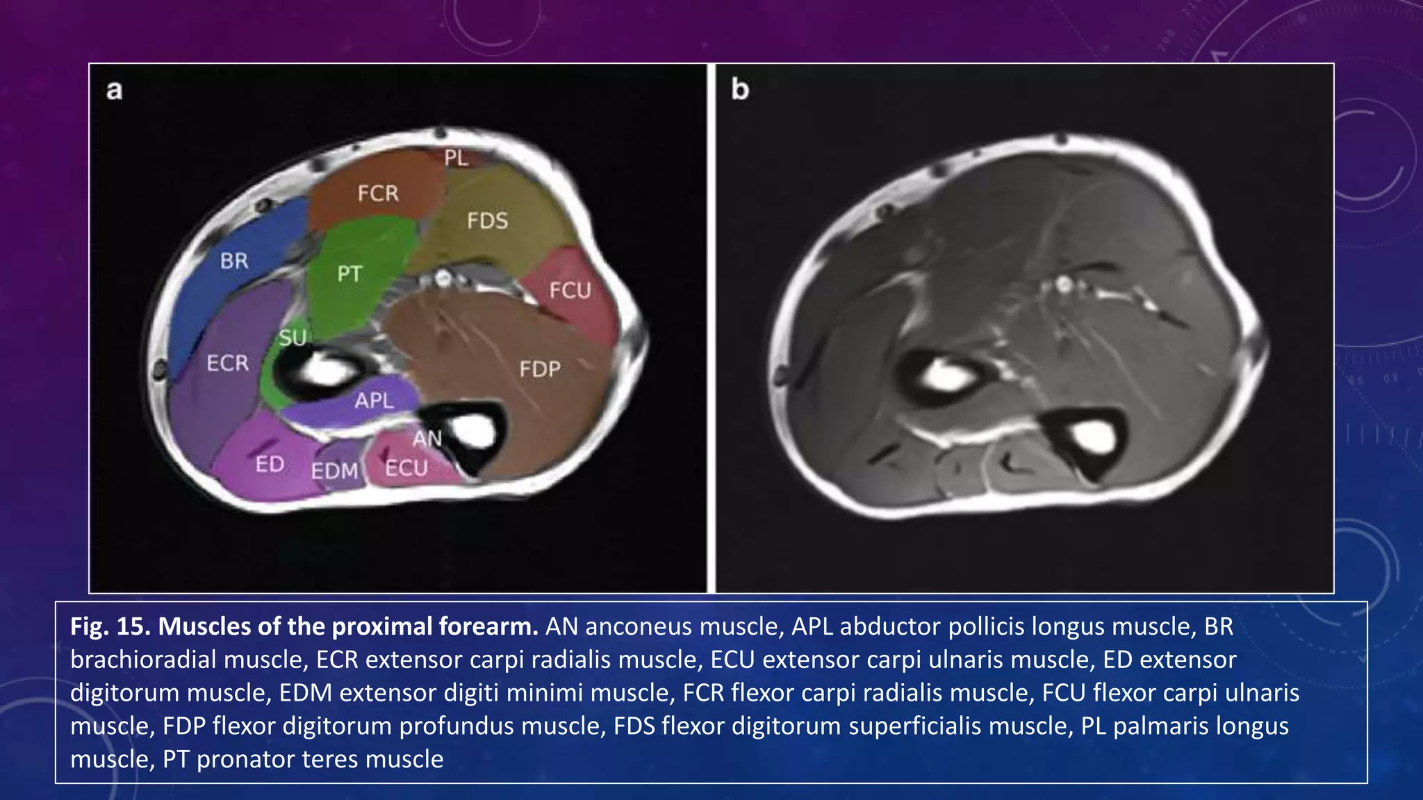 Muscle MRI in Neuromuscular Disease | PPTX