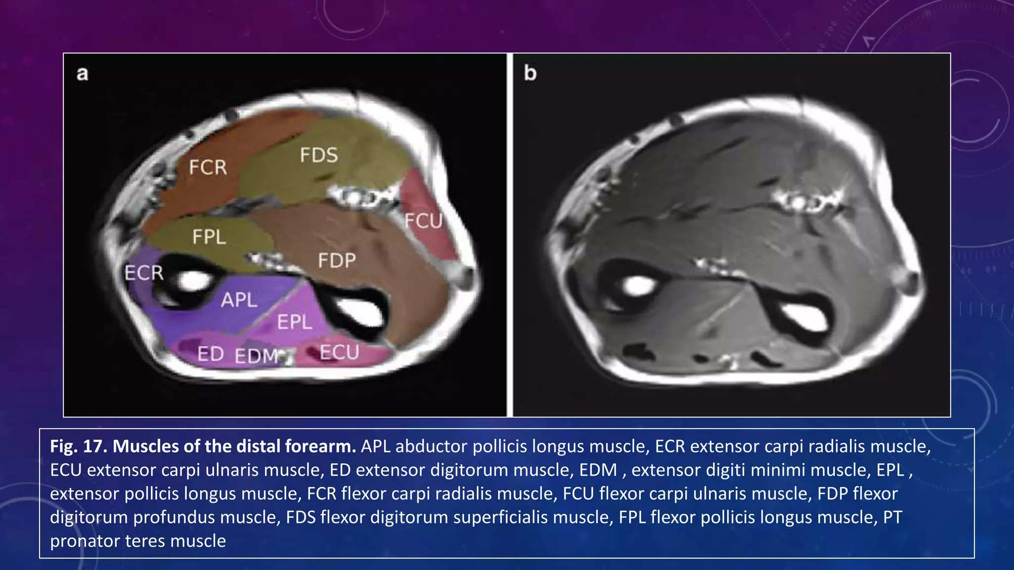 Muscle MRI in Neuromuscular Disease | PPTX