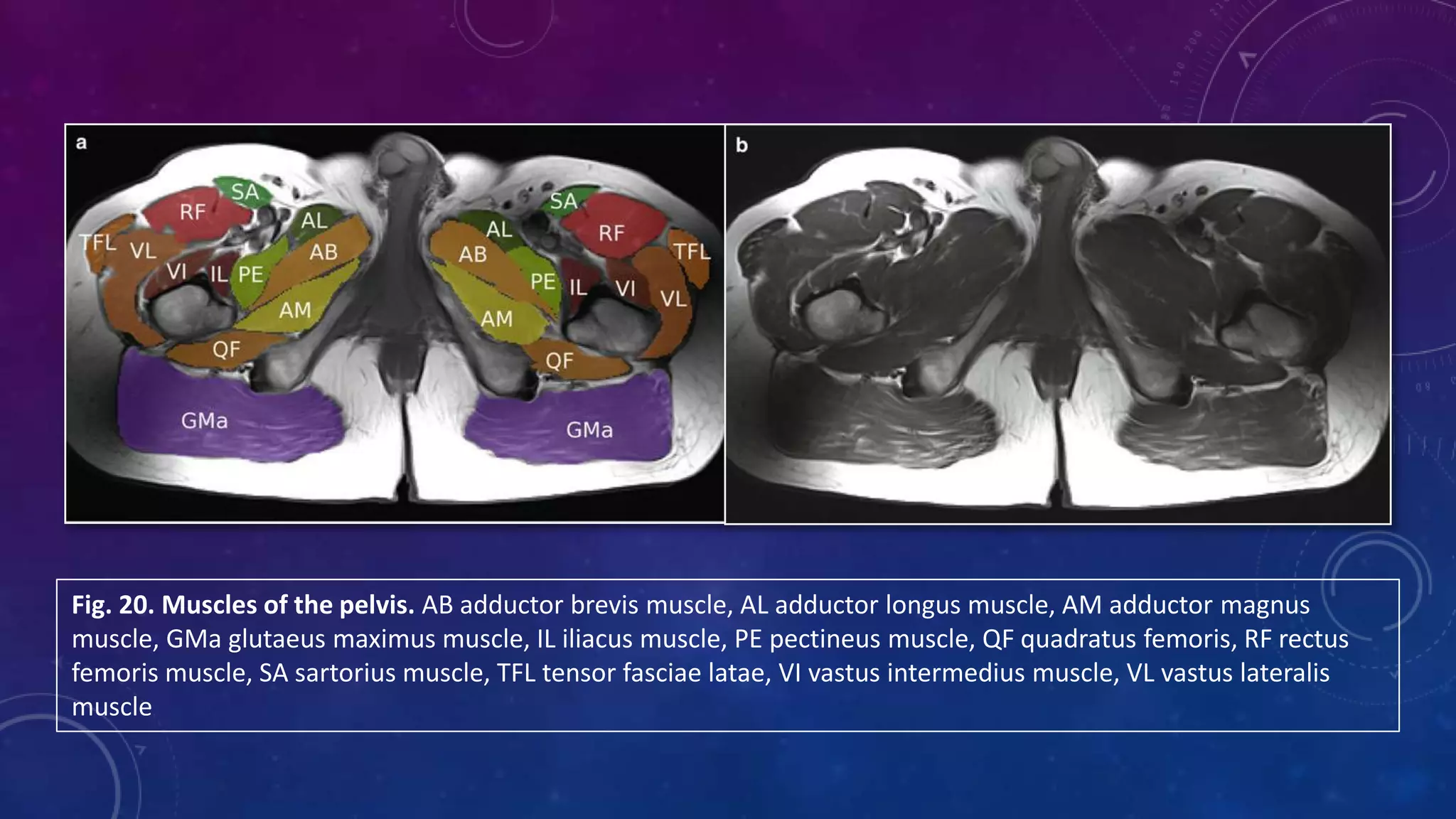 Muscle MRI in Neuromuscular Disease | PPTX