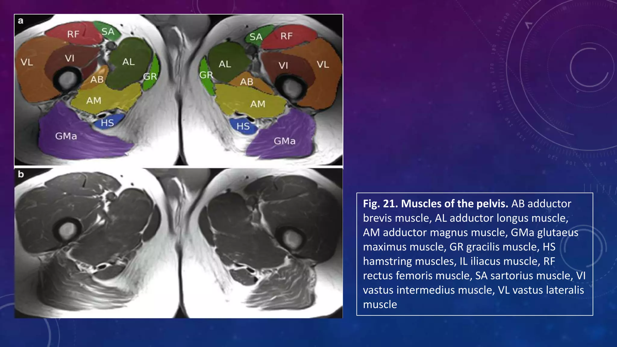 Muscle MRI in Neuromuscular Disease | PPTX