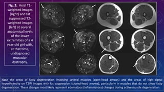 Muscle MRI in Neuromuscular Disease | PPTX