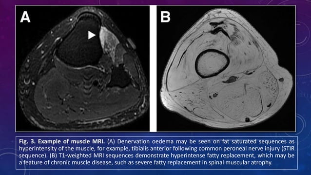 Muscle MRI in Neuromuscular Disease | PPTX