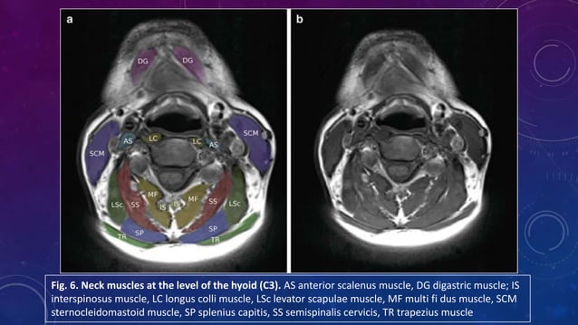 Muscle MRI in Neuromuscular Disease | PPTX