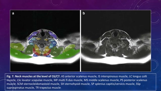 Muscle MRI in Neuromuscular Disease | PPTX