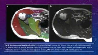 Muscle MRI in Neuromuscular Disease | PPTX
