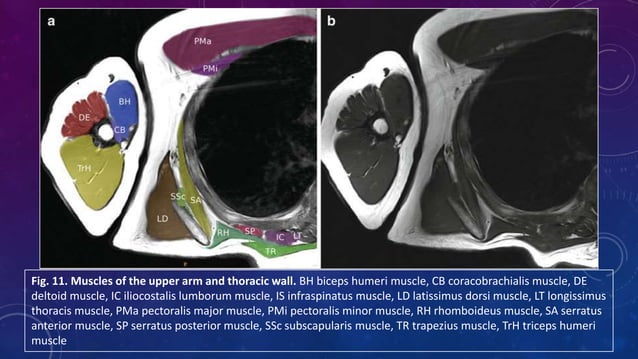 Muscle MRI in Neuromuscular Disease | PPTX