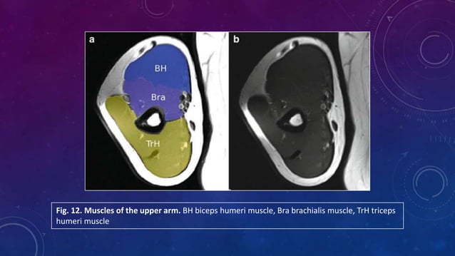 Muscle MRI in Neuromuscular Disease | PPTX