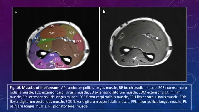 Muscle MRI in Neuromuscular Disease | PPTX