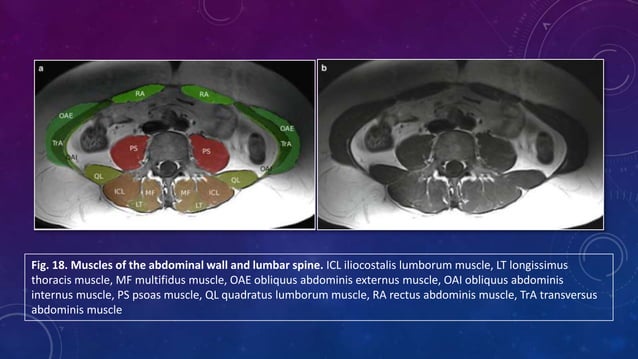 Muscle MRI in Neuromuscular Disease | PPTX