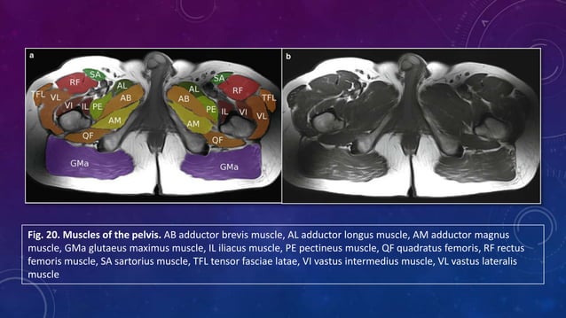 Muscle MRI in Neuromuscular Disease | PPTX