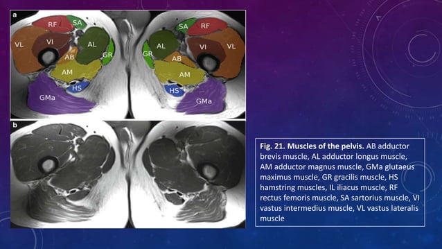 Muscle MRI in Neuromuscular Disease | PPTX