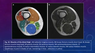 Muscle MRI in Neuromuscular Disease | PPTX