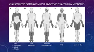 Muscle MRI in Neuromuscular Disease | PPTX