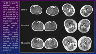 Muscle MRI in Neuromuscular Disease | PPTX