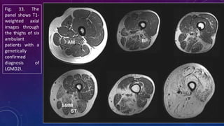 Muscle MRI in Neuromuscular Disease | PPTX