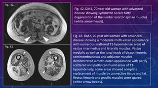 Muscle MRI in Neuromuscular Disease | PPTX