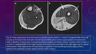 Muscle MRI in Neuromuscular Disease | PPTX