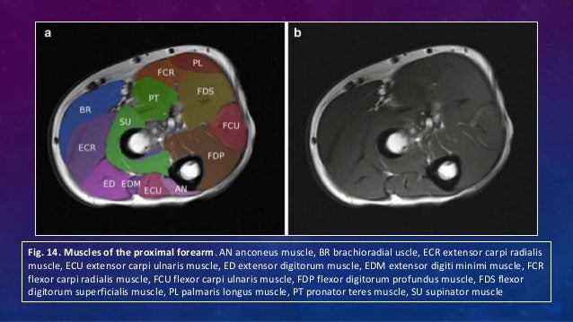 Muscle MRI in Neuromuscular Disease