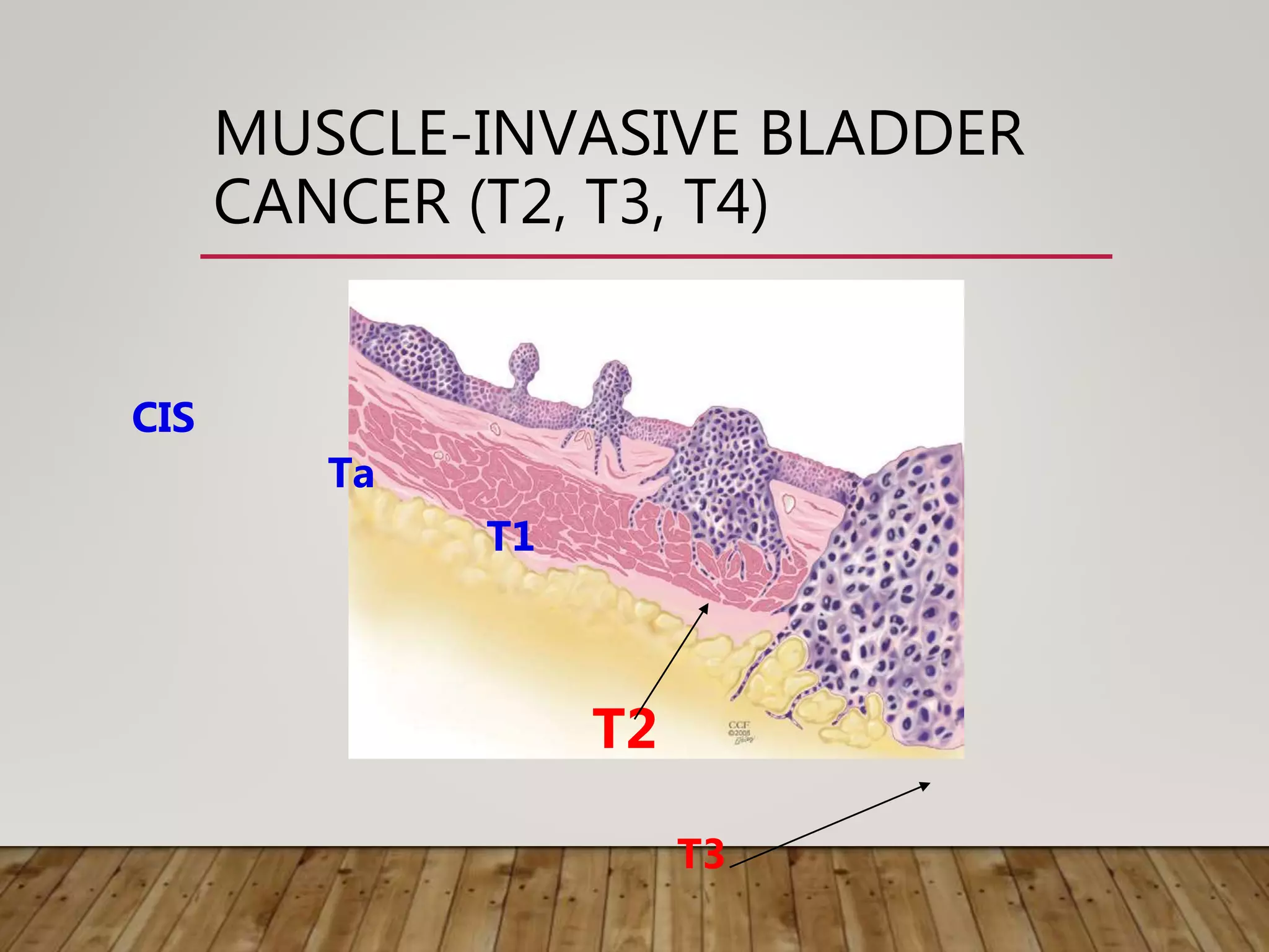 Muscle invasive bladder cancer | PPTX | Cancer | Diseases and Conditions