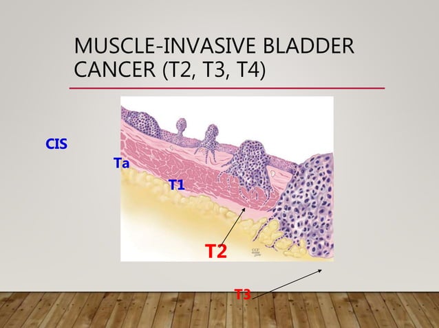 Muscle invasive bladder cancer | PPTX | Cancer | Diseases and Conditions