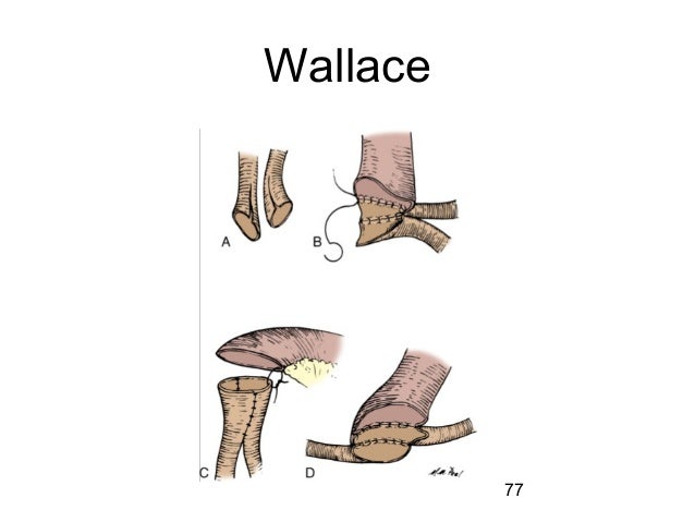 Muscle invasive bladder Cancer [Dr.Edmond Wong]