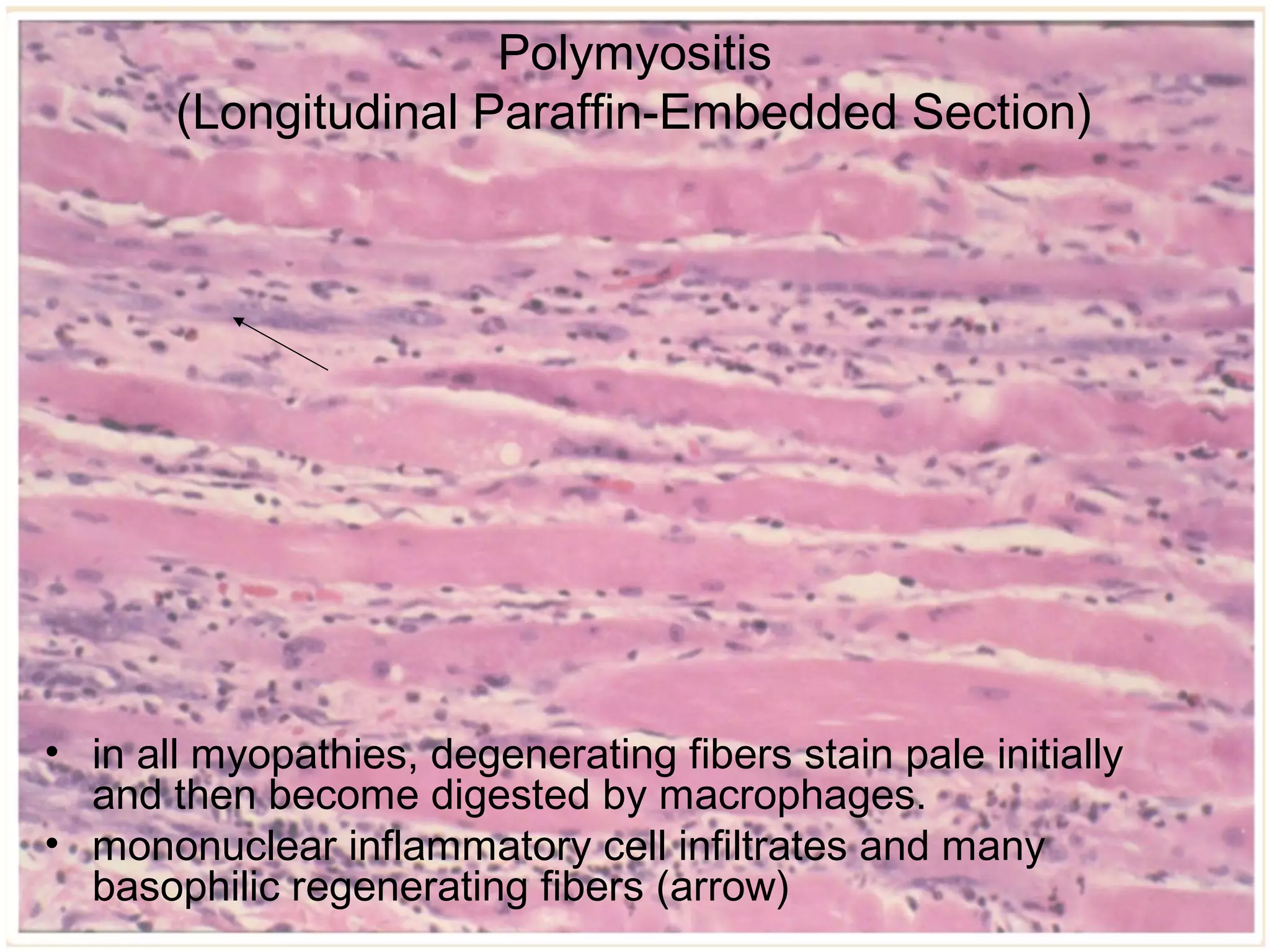 Myopathies - In detail (Classification and images) | PPT