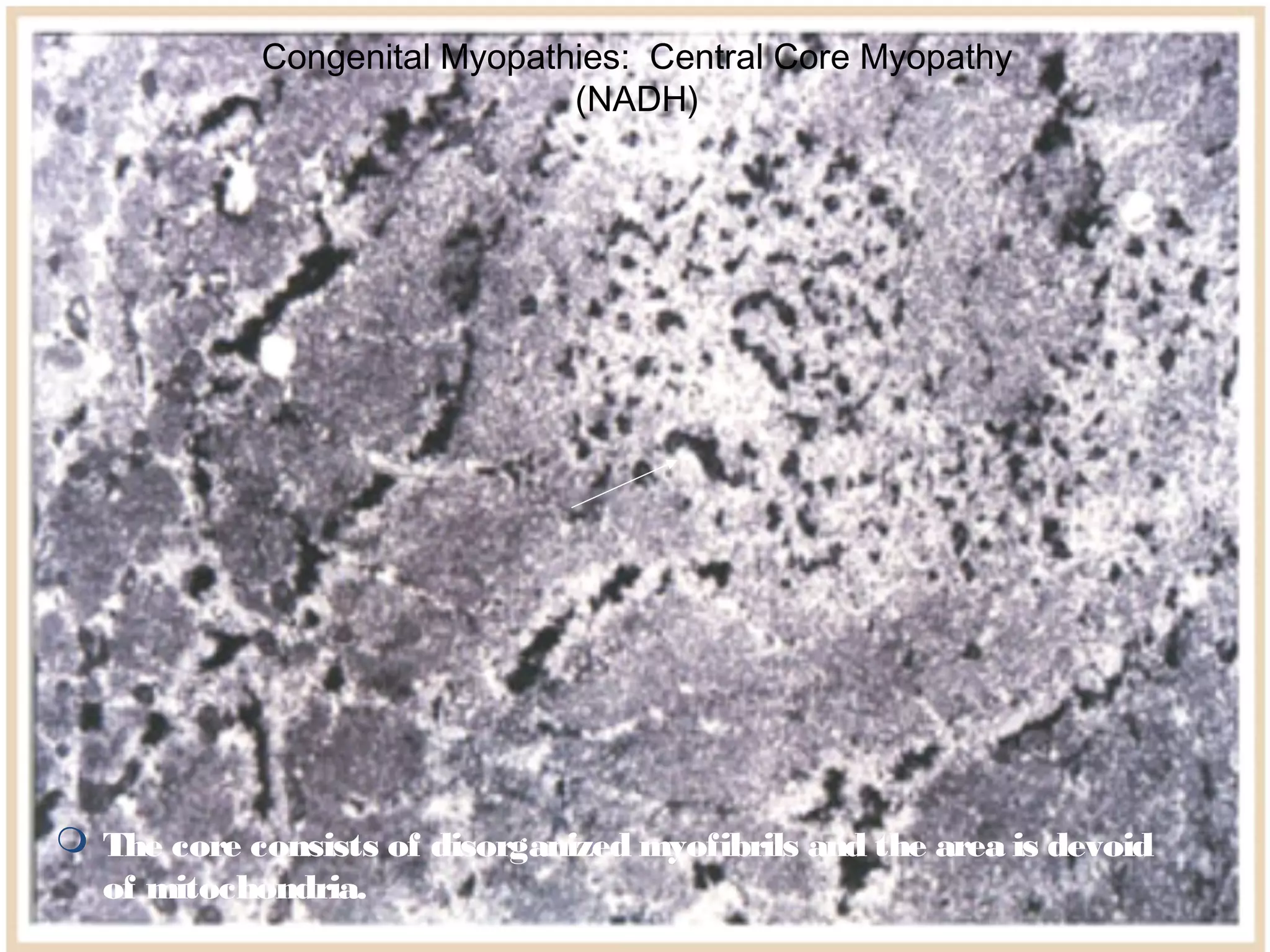 Myopathies - In detail (Classification and images) | PPT
