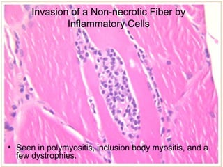 Myopathies - In detail (Classification and images) | PPT