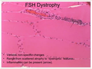 Myopathies - In detail (Classification and images) | PPT