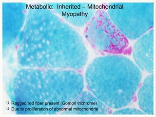 Mitochondrial Myopathy Ragged Red Fibers
