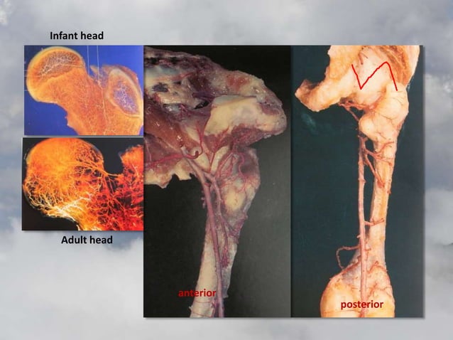 Muscle pedicle grafting for preservation of the Hip by Prof. V.S ...