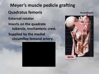 Muscle pedicle grafting for preservation of the Hip by Prof. V.S ...